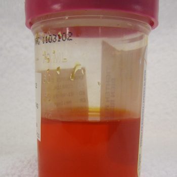 Important Urine Color Indicators To Determine How Healthy You Are